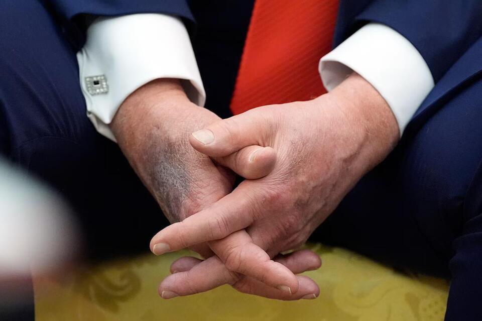 What is that bruise on Trump’s hand? Here’s the White House’s ...