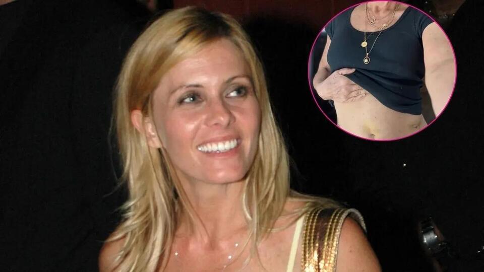 'Baywatch' Star Nicole Eggert Shows Her Bruises After Receiving Major ...