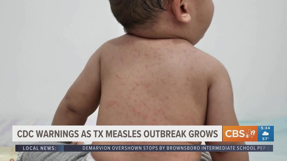CDC issues warnings as Texas measles outbreak grows - NewsBreak