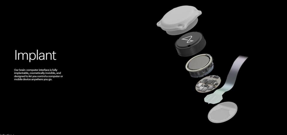 Vidalia Woman Uses Neuralink to Communicate for First Time in 20 Years ...