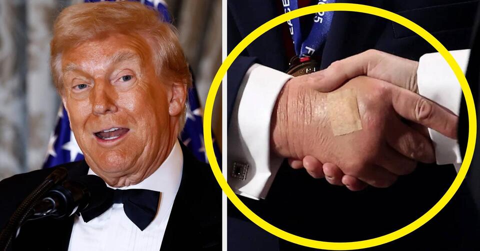 A New Picture Of Donald Trump's Hand Certainly Has People Noticing Some ...