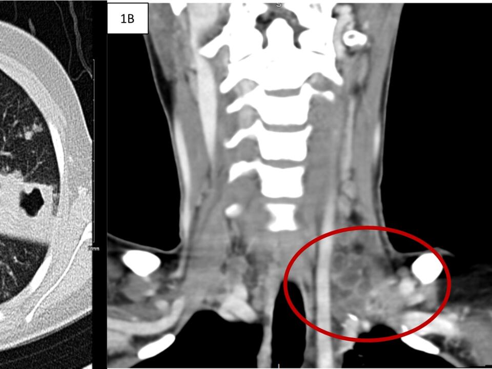 Left hand abscess as a paradoxical reaction during treatment of ...