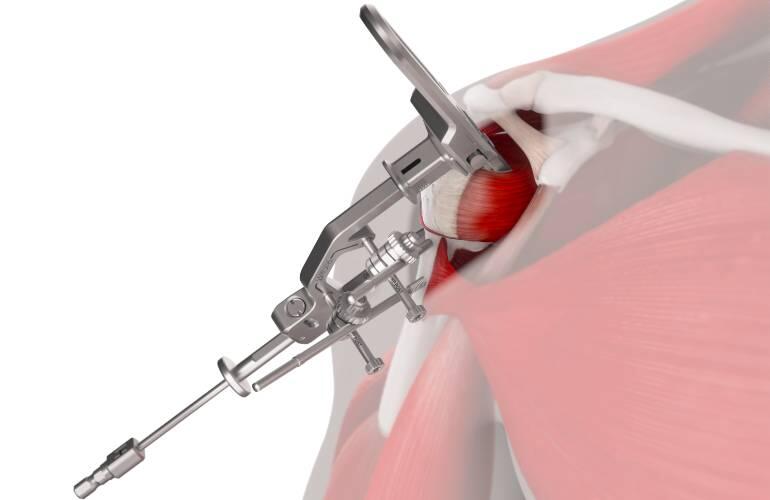 Johnson & Johnson MedTech launches Inhance Intact shoulder ...