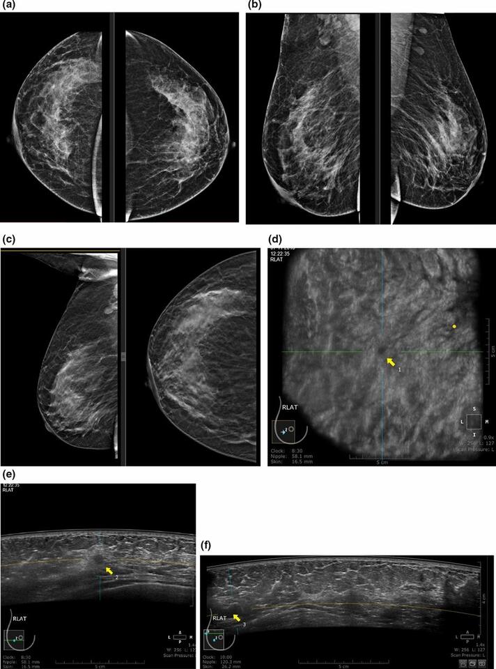 Digital breast tomosynthesis and automated breast ultrasound: added values in women with dense ...