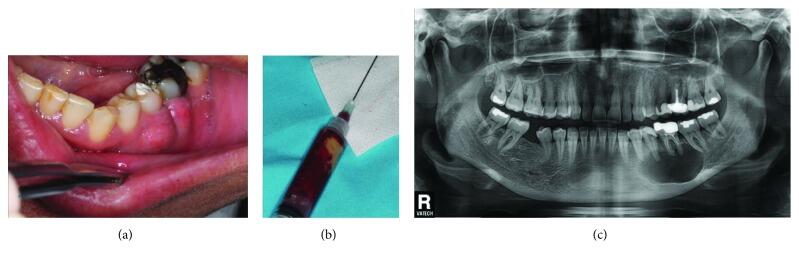 Decompression and Enucleation of a Mandibular Radicular Cyst, Followed ...