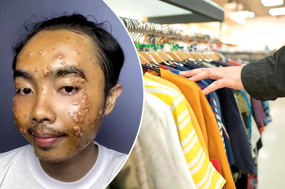 This man contracted a shocking skin disease from wearing thrifted ...