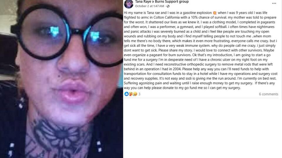 Former Gymnast Tana Raye Survived a Devastating Gasoline Explosion at ...