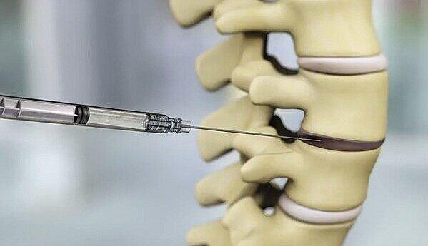 FDA Approves Stem Cell Study for Degenerative Disc Disease - NewsBreak
