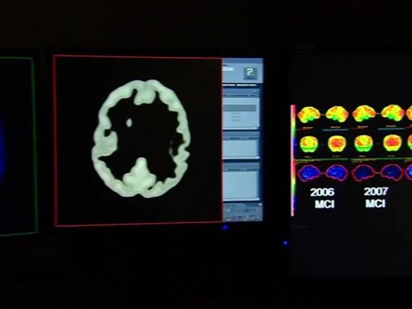 Test a 'game changer' in brain injury care