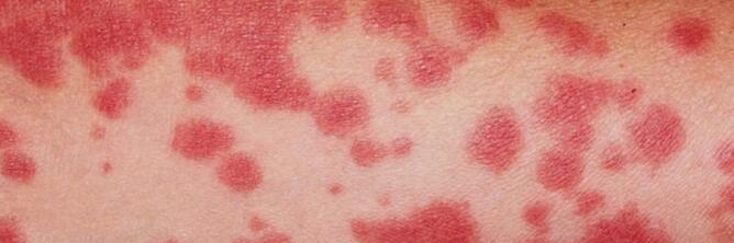 Common Infections and Risk Factors in SJS and TEN - NewsBreak