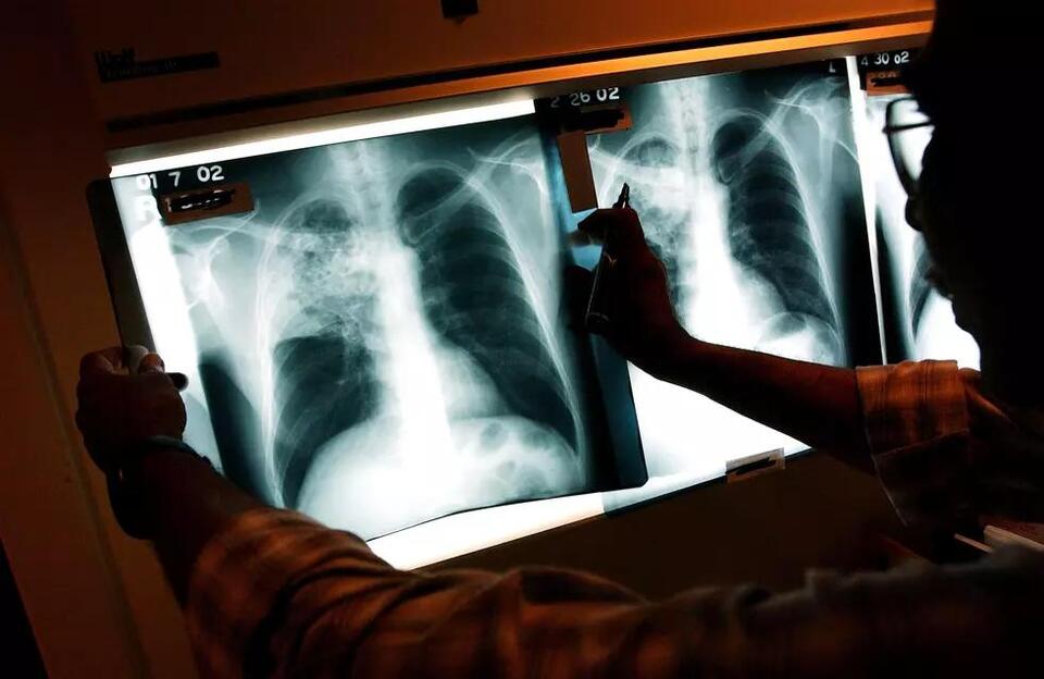 Oklahoma Health Officials Monitoring Alarming Tuberculosis Outbreak In ...