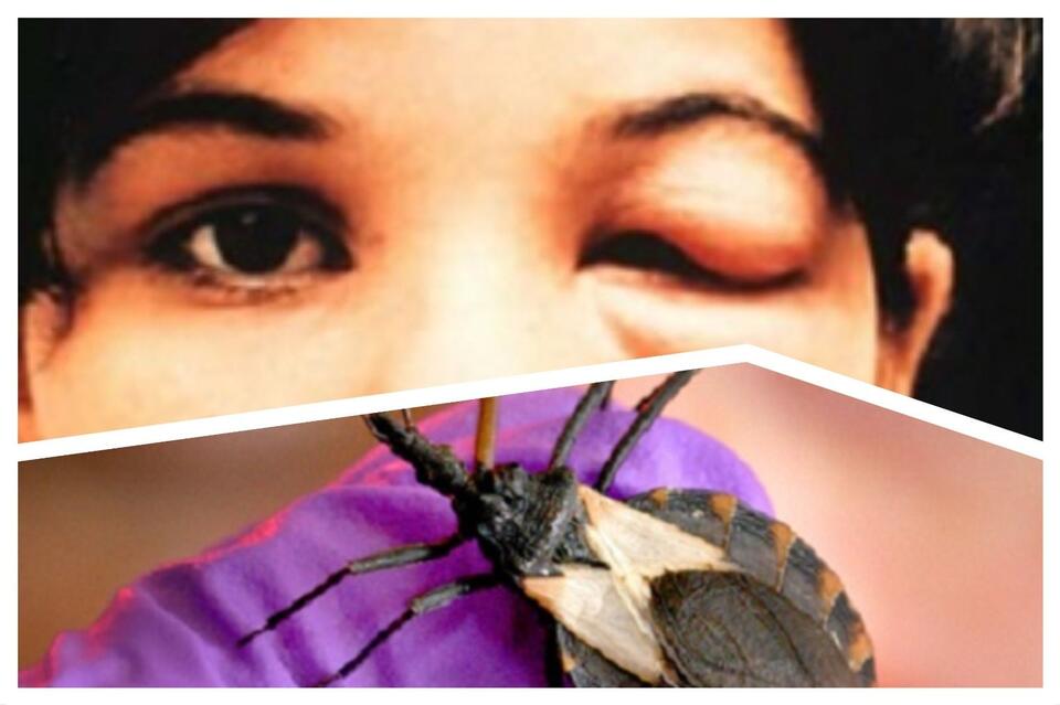 Deadly Face-Biting Kissing Bug Closing In On New York State - NewsBreak