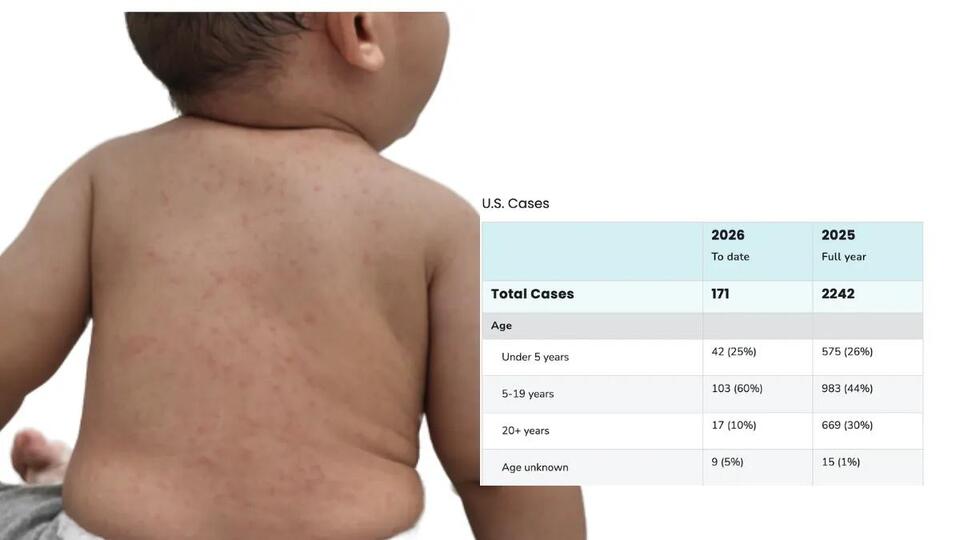 Alert! Measles Is Back In The US - NewsBreak