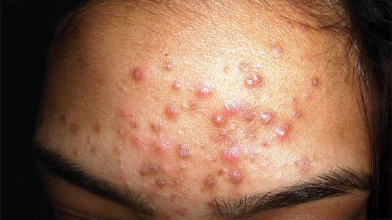 Skin Care Regimen Cuts Toxicities of Combination NSCLC Therapy - NewsBreak