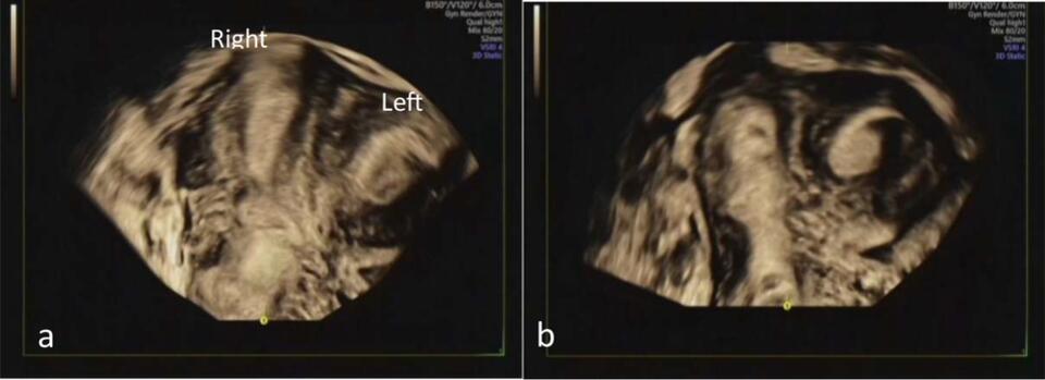 A new treatment for Robert’s uterus with adenomyosis: a case report and ...