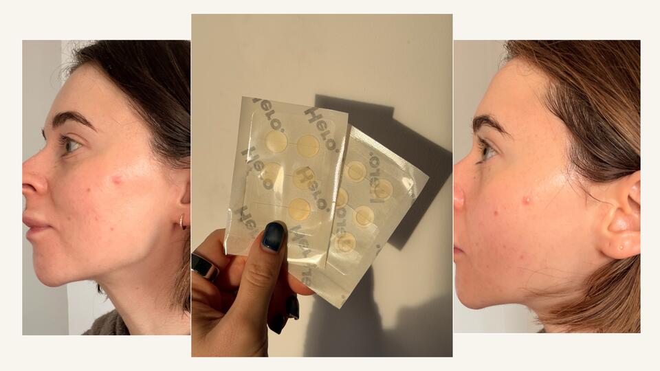 I Tested the Internet’s Most-Loved Spot Patches—Here’s Why They’re ...