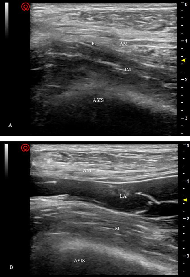 Median effective concentration of ropivacaine for preoperative ...