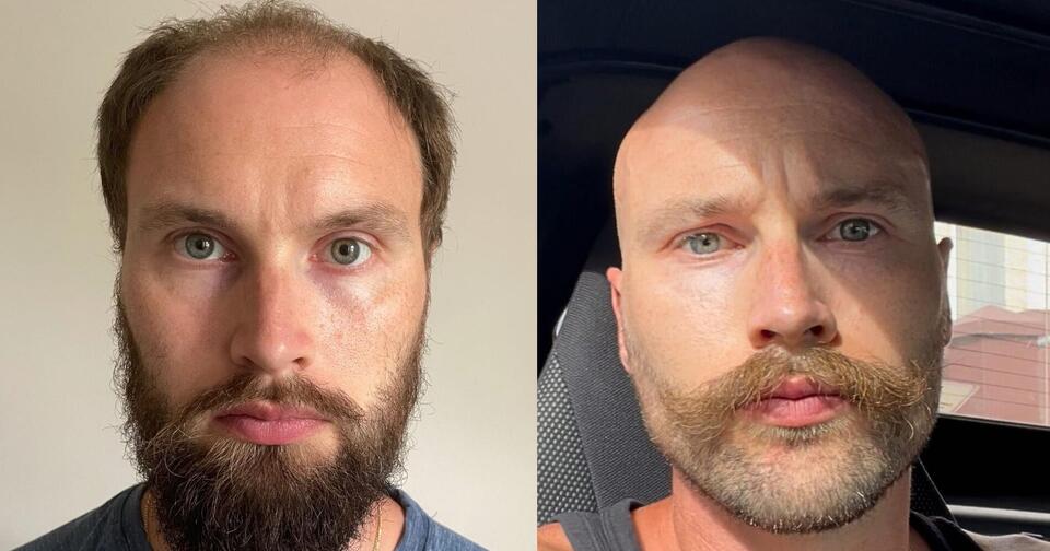 'Baldmaxxing': Some men fear hair loss. These men are embracing it ...
