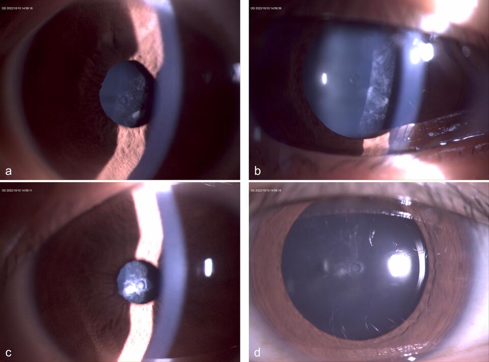 Recurrent 0 μm vault complicated with anterior subcapsular cataract ...