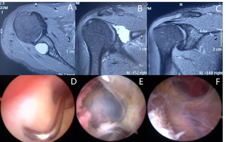 Arthroscopic management of spinoglenoid notch cysts: with and without ...