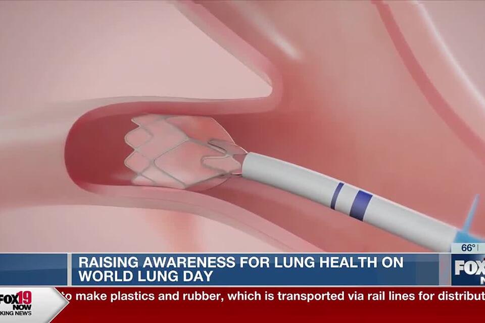 Christ Hospital offers Zephyr Valve to Patients with Lung Disease ...