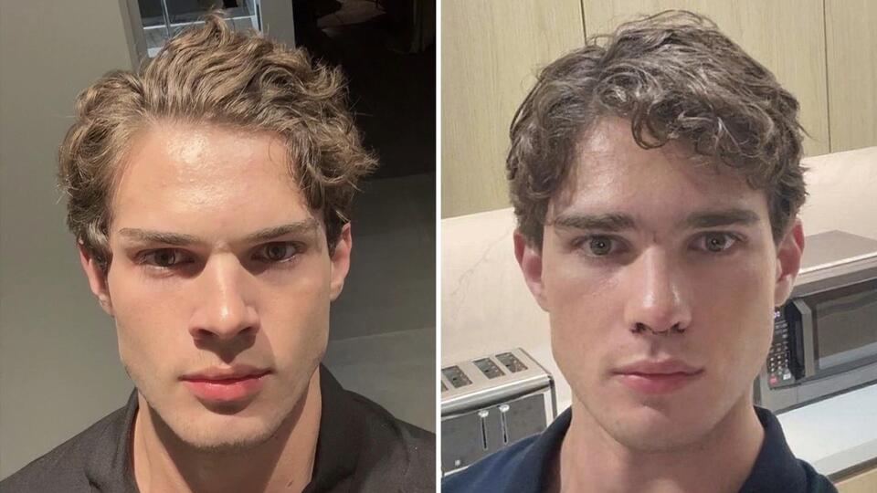 Looksmaxxing Influencer Clavicular Faces Criticism Over New Nose: ‘Too ...