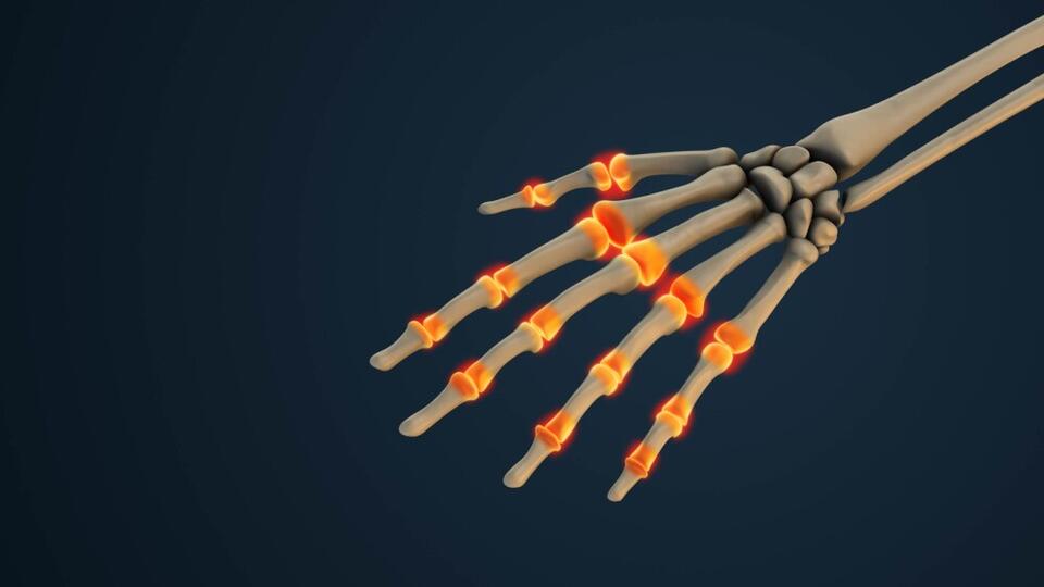 Novo-Backed Crystalys Debuts With $205M to Tackle Gout - NewsBreak