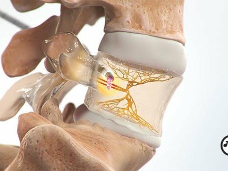 Discover a Minimally Invasive Procedure Transforming the Treatment of ...