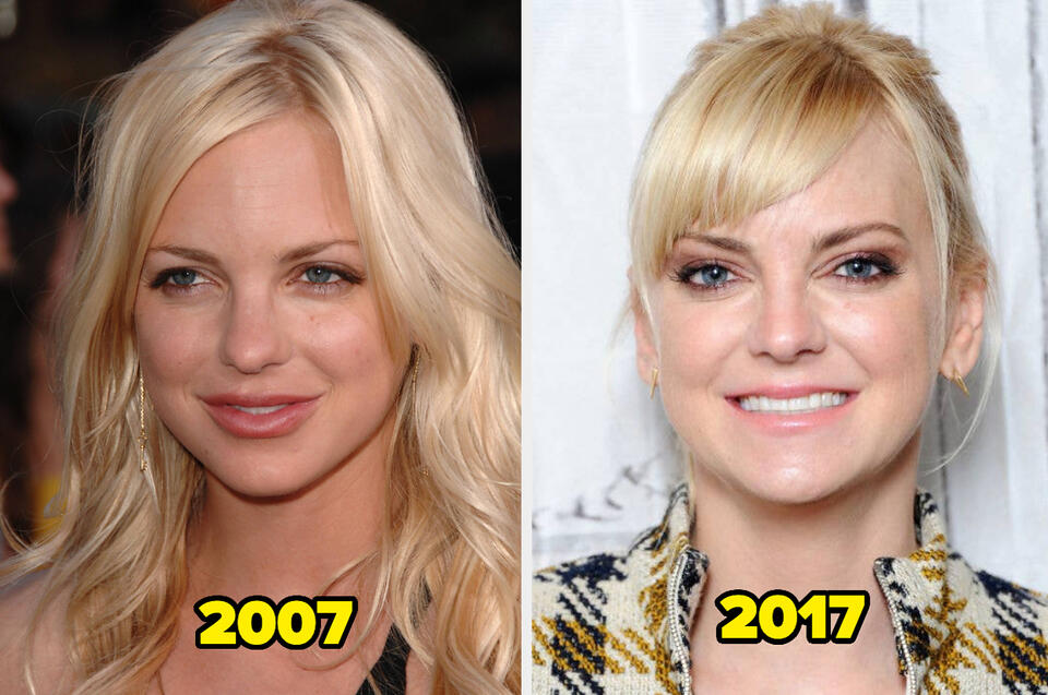 17 Celebs Who Dissolved Or Stop Getting Facial Fillers (And Why ...