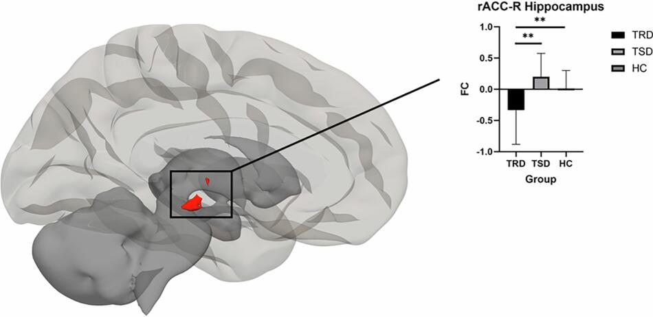 Role of the rostral anterior cingulate cortex in emotion processing in ...