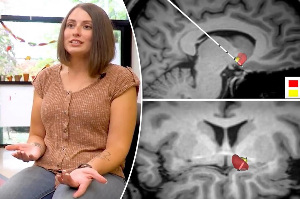 Patient’s OCD, epilepsy curbed with electrical brain implant: ‘This is ...