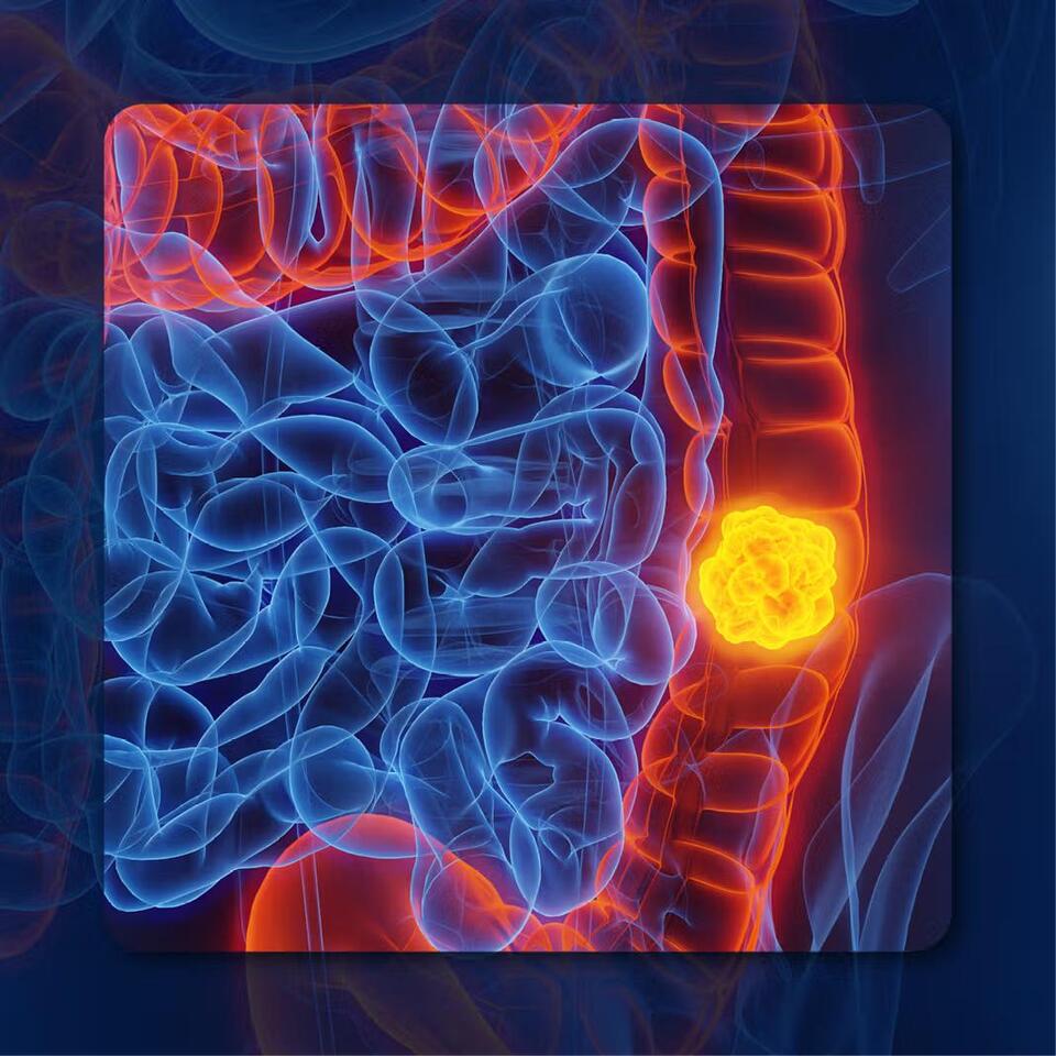 NCCN Updates ctDNA Stance in Colon, Rectal, and MCC Guidelines - NewsBreak