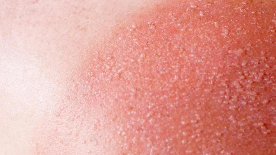 Bothered by Red, Itchy Skin on Hot Days? Doctors Share How To Get Rid ...