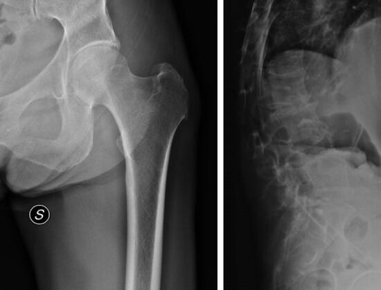 Delayed diagnosis and treatment of a psoas abscess as a link between ...
