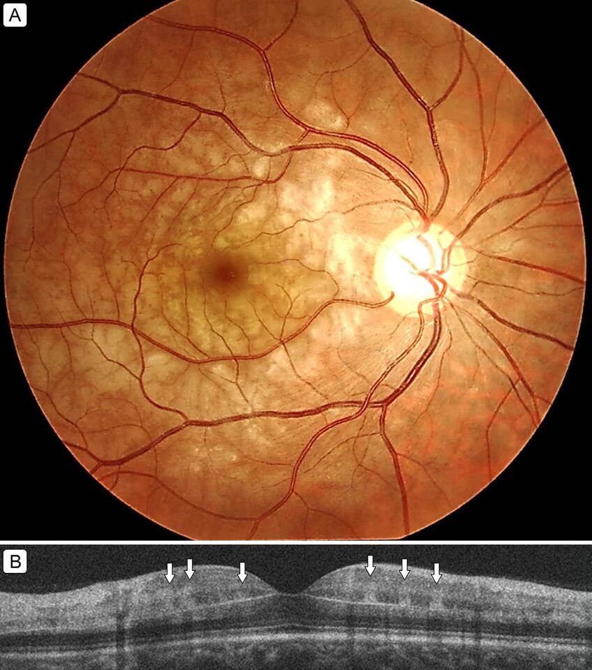 OCT Reveals PAMM as a Key Biomarker in Ocular Ischemia - NewsBreak