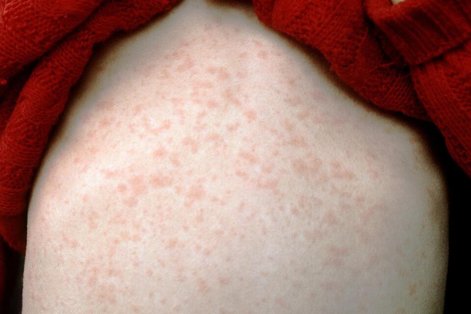 Measles Warning Signs Growing: How Concerned Should We Be? - NewsBreak