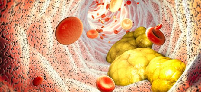 Gender Disparities and Treatment Gaps in LDL-C - NewsBreak