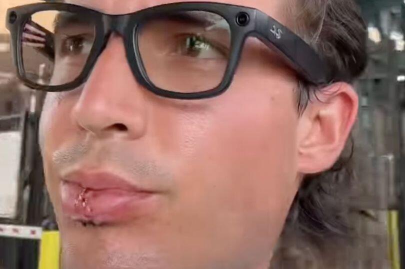 CNN guest who face-planted after backflip mishap unveils horror injury ...