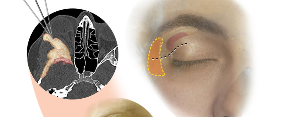 The transorbital approach for minimally invasive skull base surgery ...
