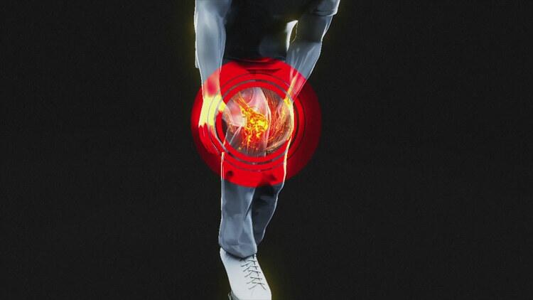 Breaking down one of the most common overuse injuries seen in young ...