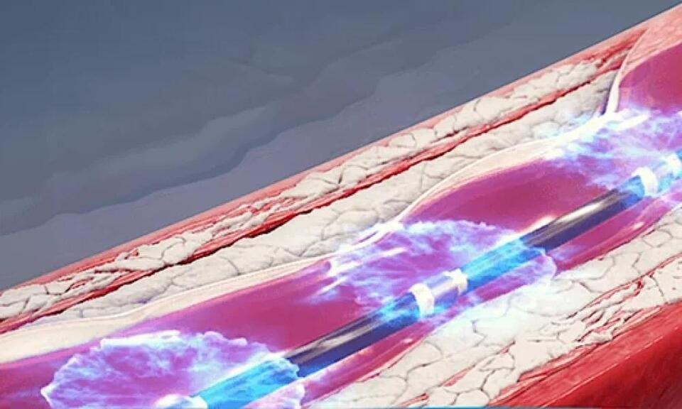 Intravascular Lithotripsy (IVL) Market to Reach US$2,837.7 Mn by 2032 ...