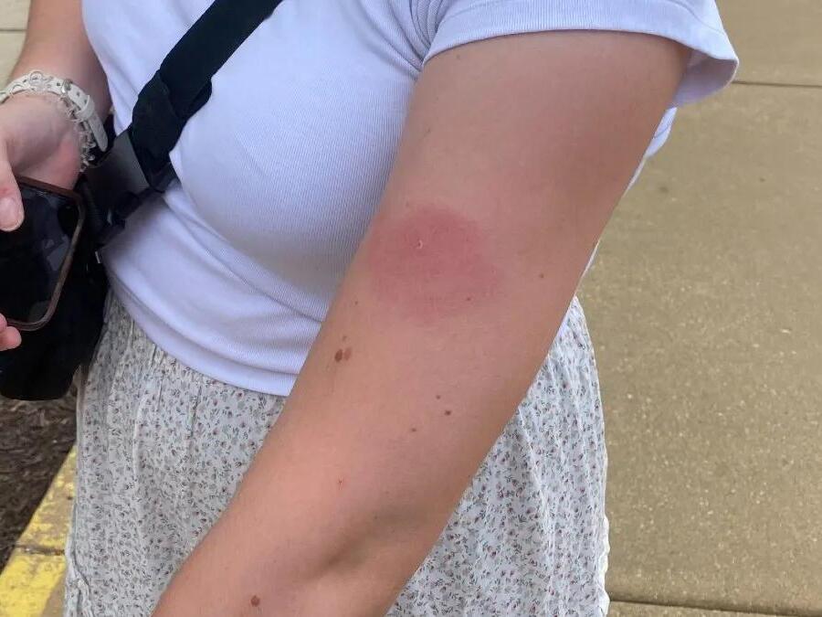 Noticing strange, itchy mite bites? It might be from the 2024 cicada ...