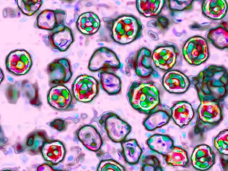 Measles outbreak in Chicago: Two new cases reported, total reaches 17
