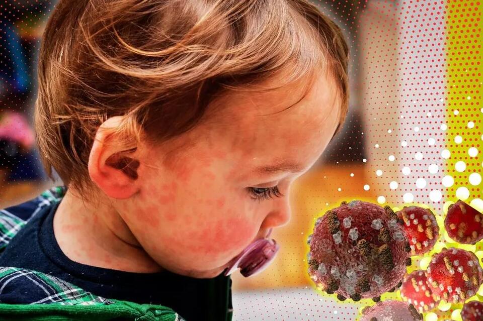 Measles Outbreak in Texas Raises Concerns Across State Lines - NewsBreak