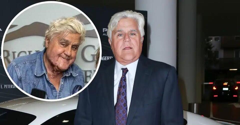 Jay Leno Jokes About Getting A Third Face And “Brand New Ear” After String Of Motor Vehicle ...