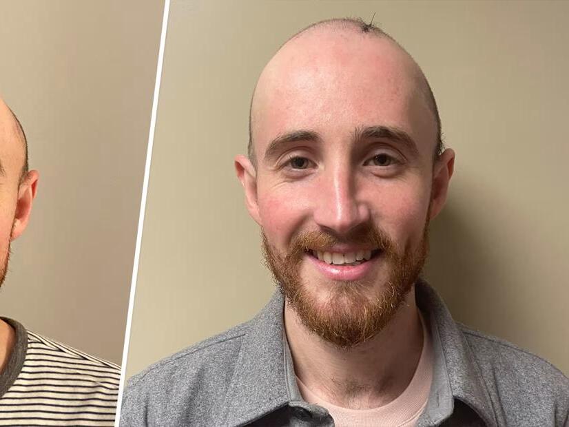 A fall fractured his skull and left him with a dented head: A 3-D ...