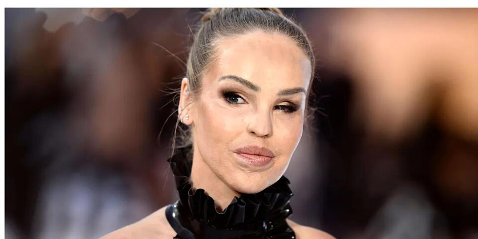 Katie Piper Reveals She Has Undergone Another Surgery - Video - NewsBreak
