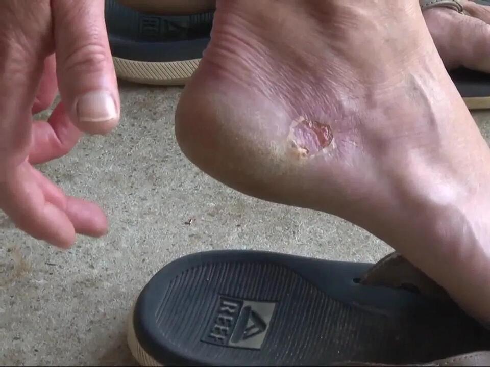 Man contracted a flesh-eating bacteria after walking on Lowcountry beach
