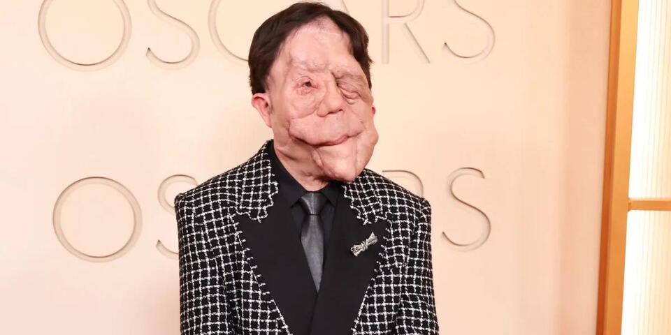 British Actor Adam Pearson, Who Lives with Neurofibromatosis, Arrived ...