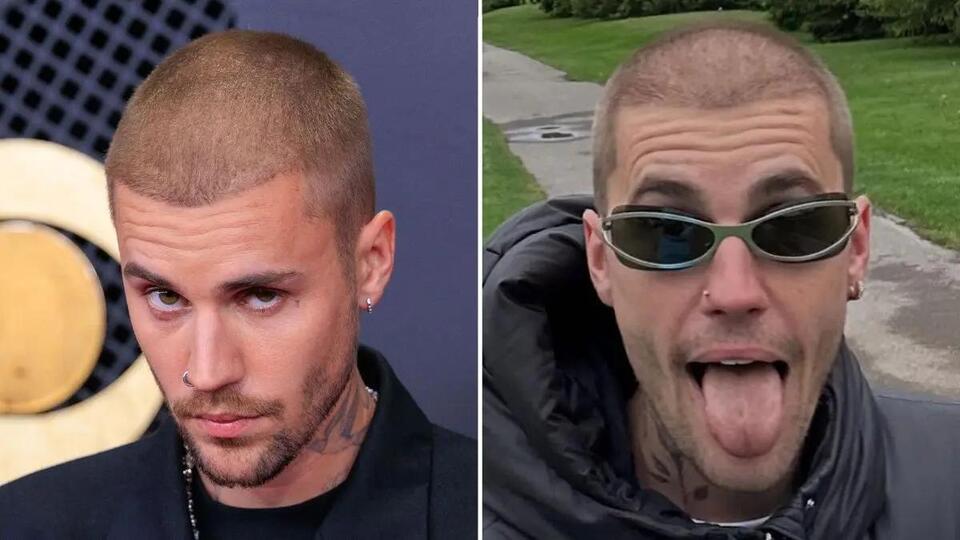 Justin Bieber Sparks Hair Transplant Rumors: Singer Shocks Fans with ...